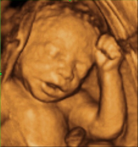 What is a 3D Ultrasound? | Sneak A Peek Imaging 3D4D Ultrasounds